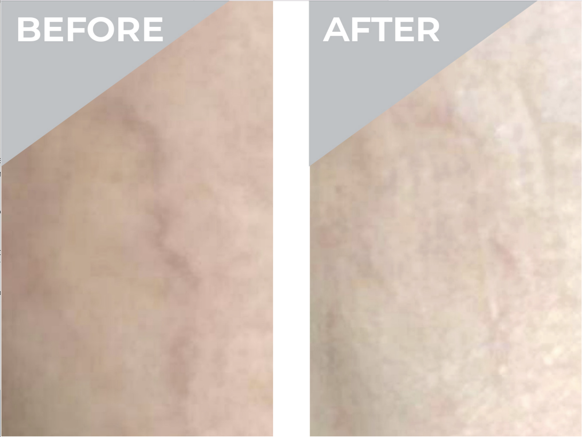Thread Vein Removal | Vasculase | Olive Beauty & Aesthetics